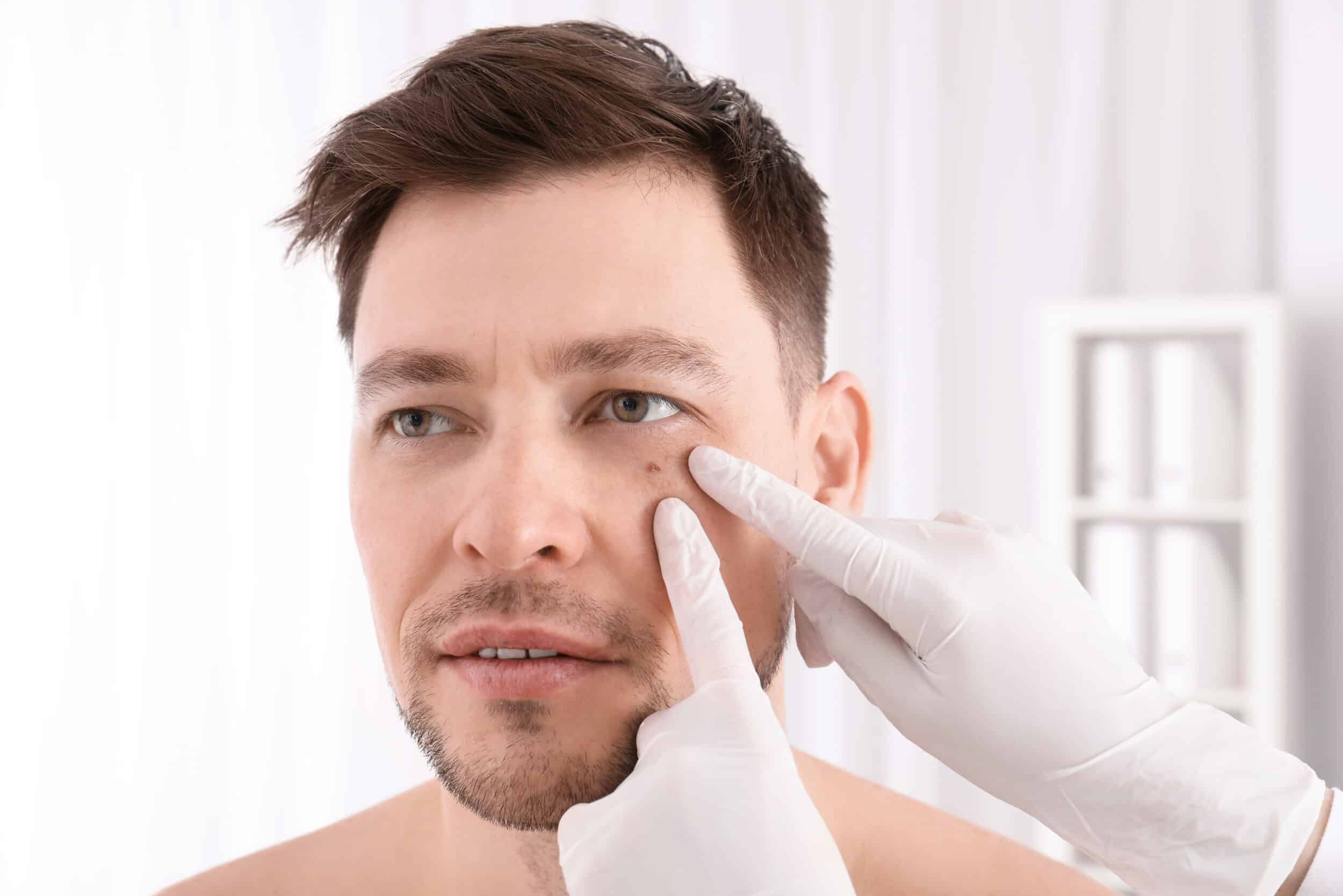 Mole Warning Signs and When to Get a Skin Check in Lubbock, TX